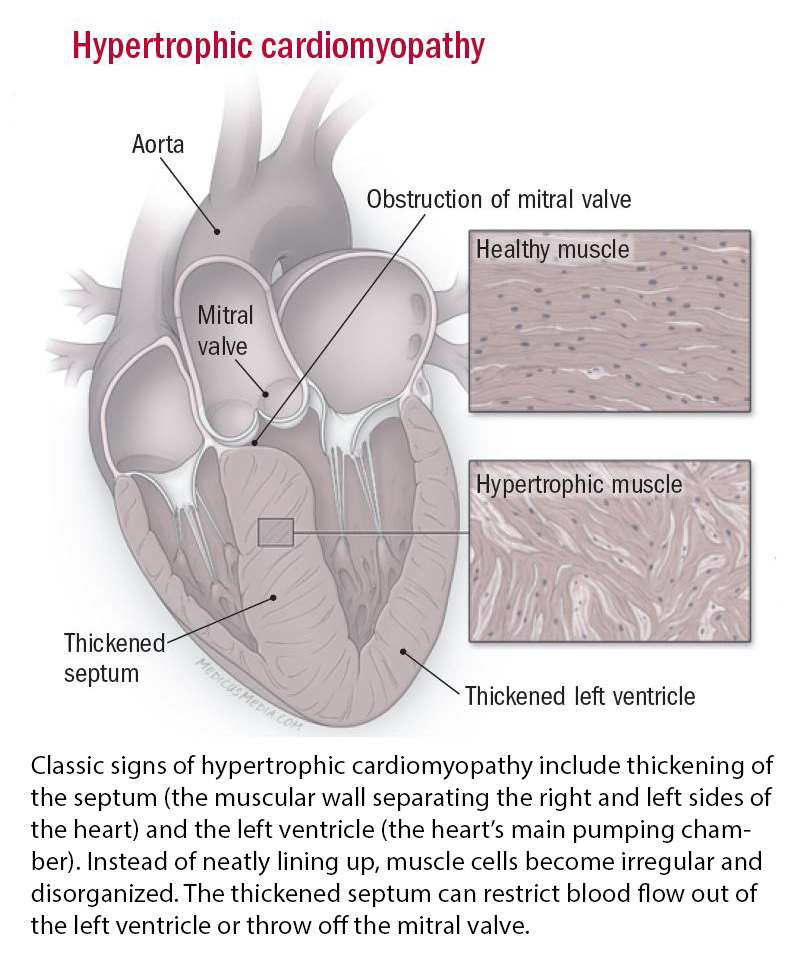 Cardiomyopathy Symptoms Diagnosis And Treatment Harvard Health